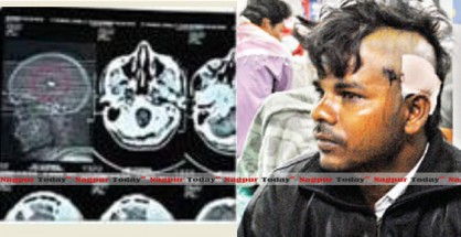 Docs remove misfired bullet from youth’s skull - Nagpur Today : Nagpur News