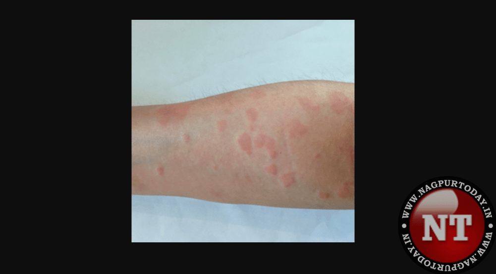 Beware: This skin disease is on the rise in Maharashtra!
