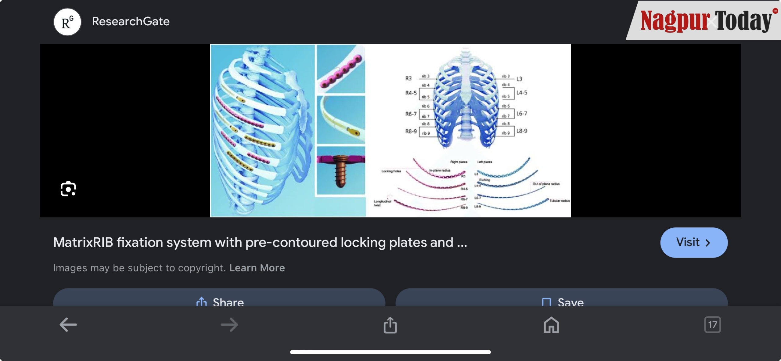 Groundbreaking Rare Surgery Saves A Young Patient with Severe Flail ...