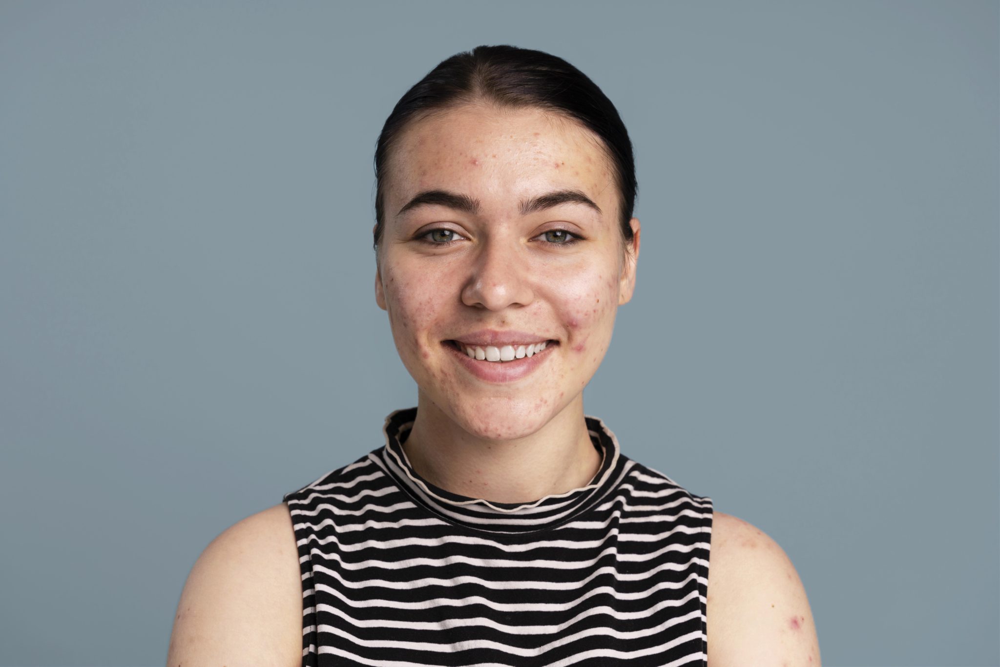 The Root Cause of Adult Acne: Why Topical Creams Alone Don’t Work
